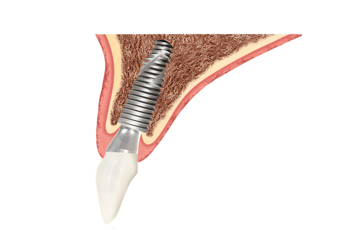 Имплантация зубов Neodent by Straumann